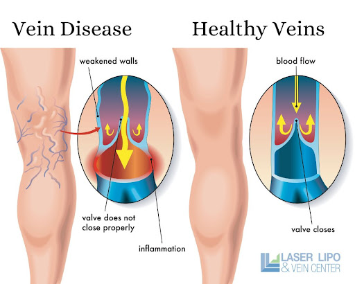 Vein Disease Stages Signs And Pictures St Louis Vein Treatment And Doctor
