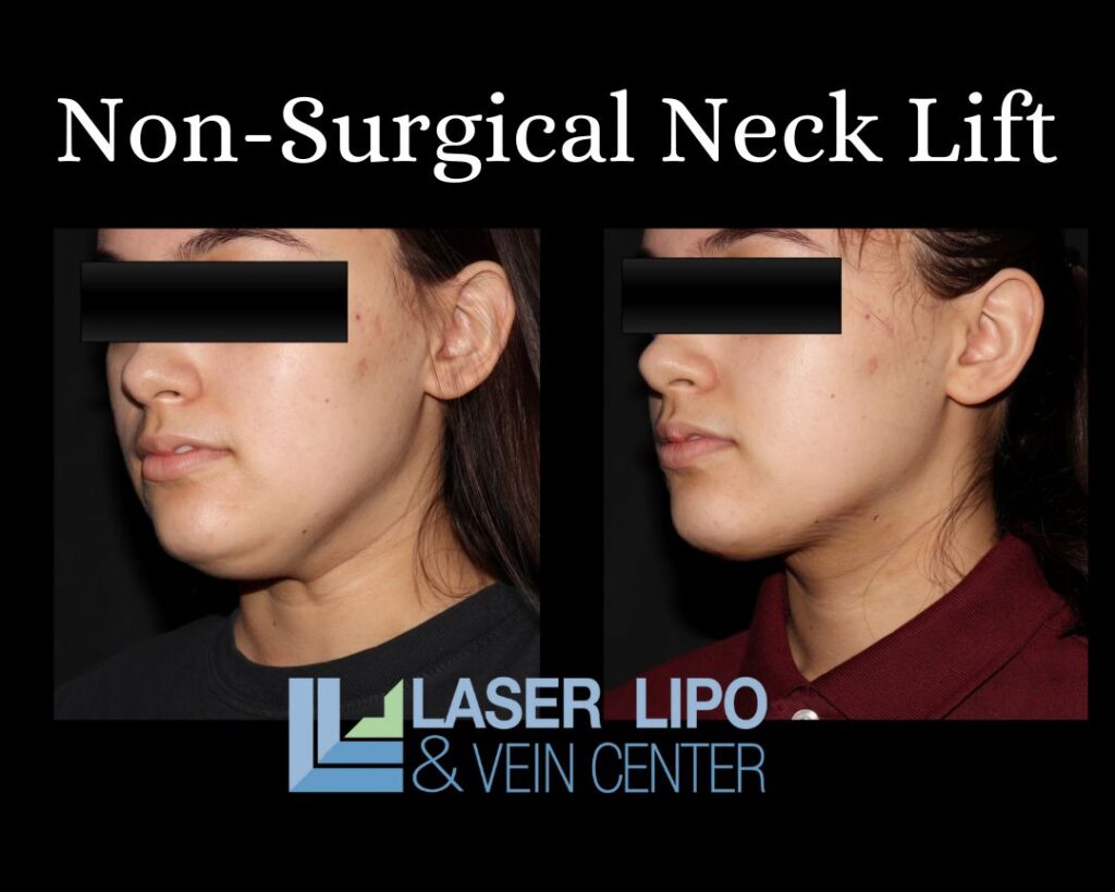 Chin Lipo and Non Surgical Neck Lift | Laser Lipo and Veins