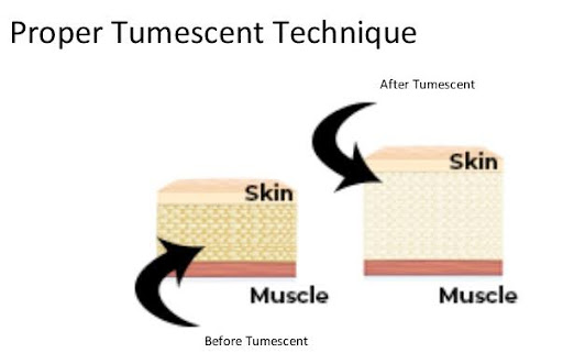 Local Anesthesia vs General Anesthesia | Laser Lipo and Vein Center
