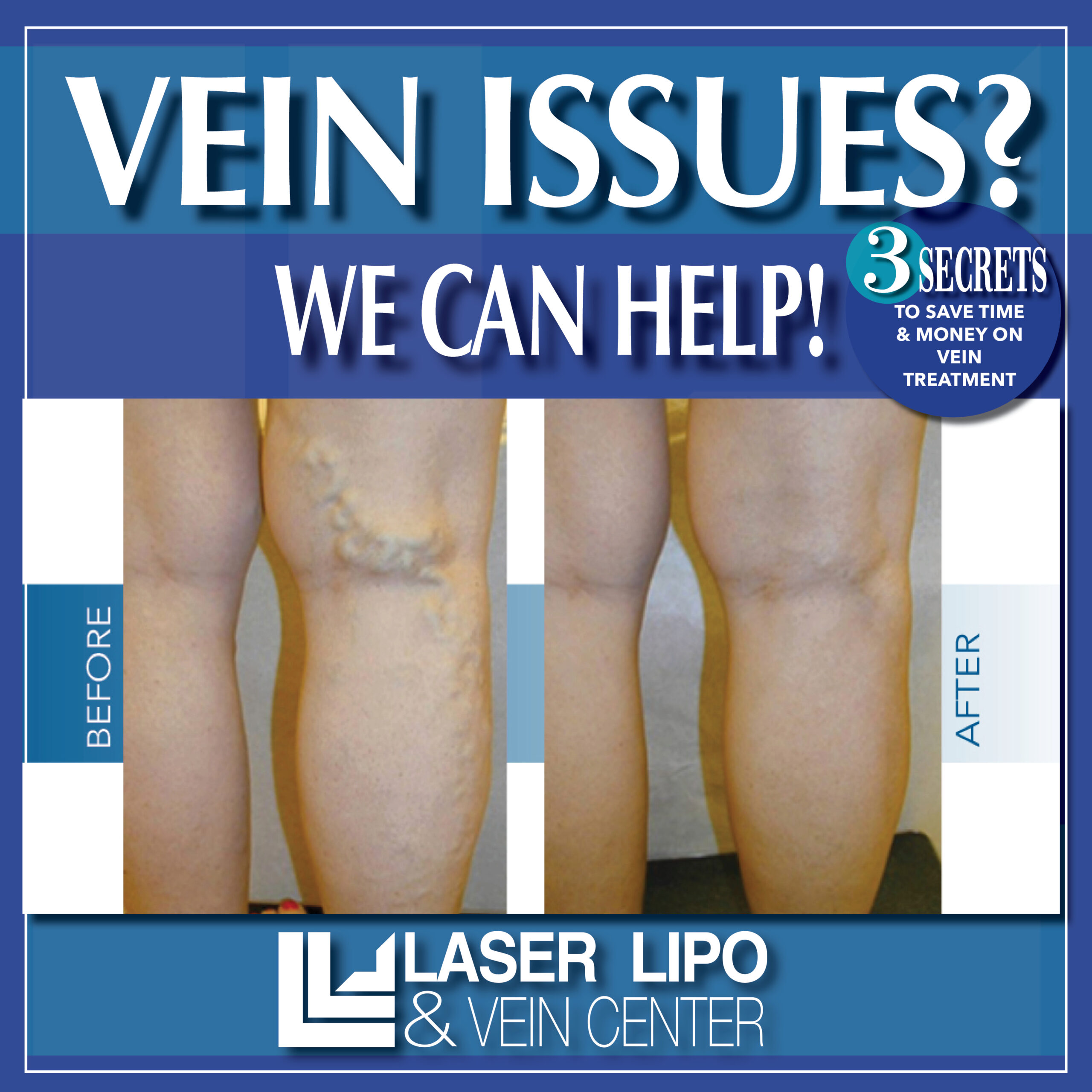 3 Secrets of Treatment for Varicose Veins | Laser Lipo and Vein Center