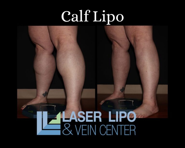 Achieve Contoured Calves with Calf Liposuction | Laser Lipo and Veins