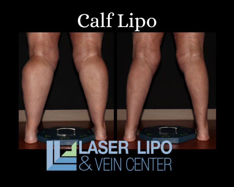 Achieve Contoured Calves with Calf Liposuction | Laser Lipo and Veins