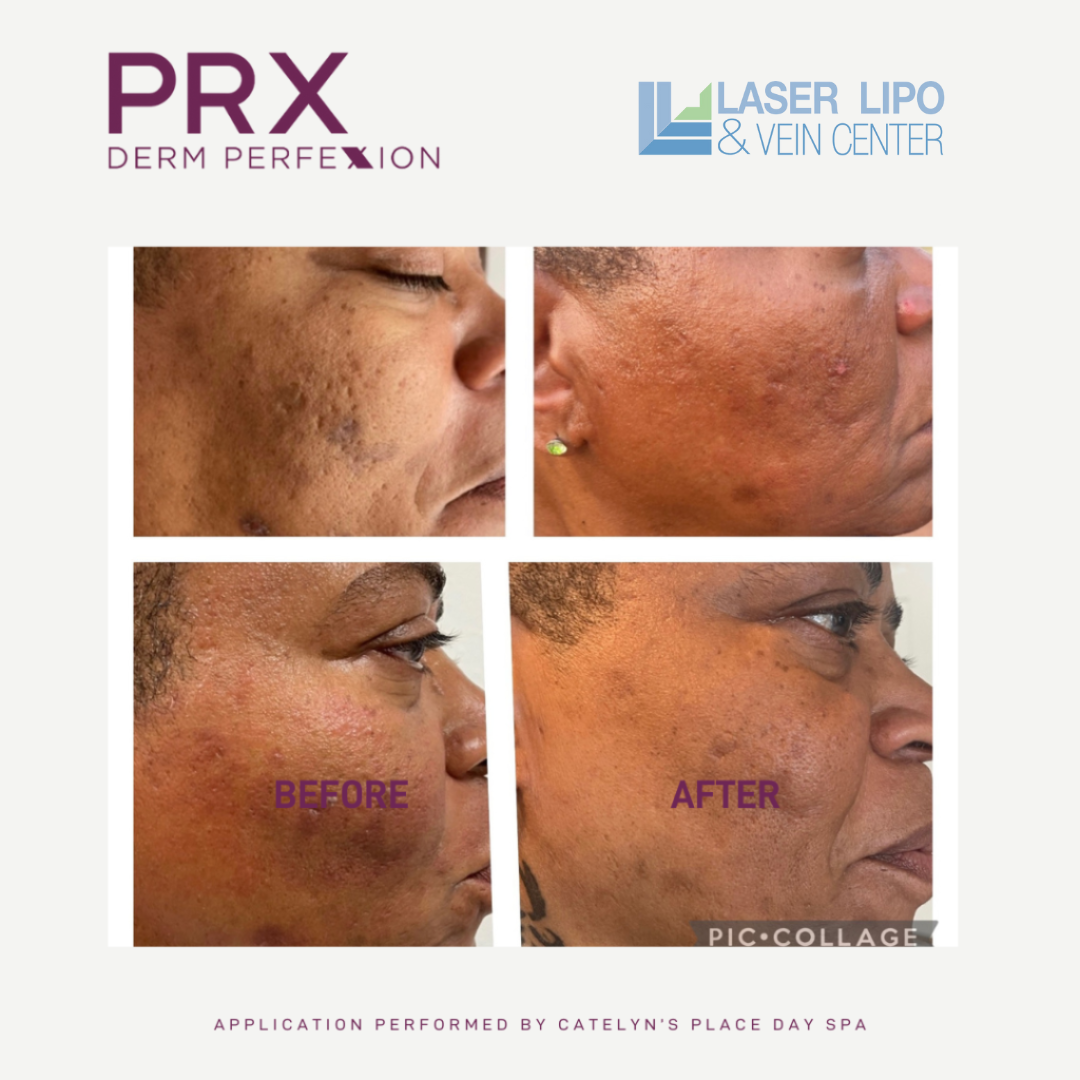 Discover Youthful Radiance with PRX Skin Biostimulation - Laser Lipo